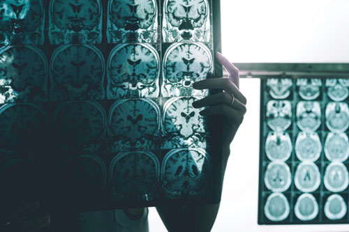 Mapping Dementia: How to Recognize the Stages of Dementia – St. Louis ...